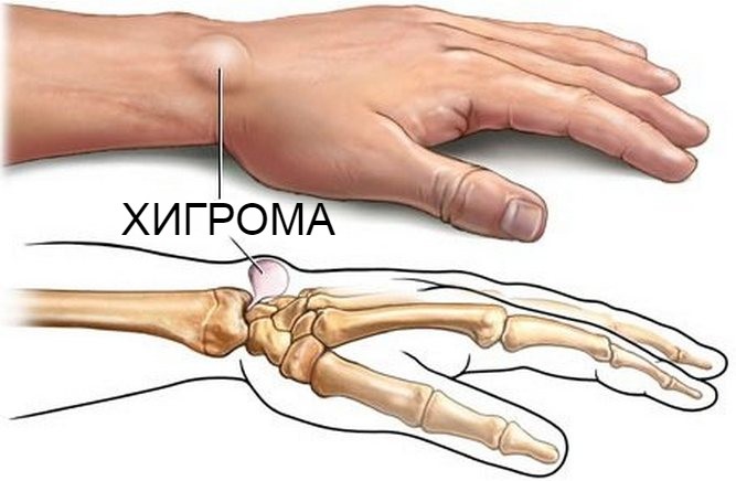 Хигрома на ръката: симптоми и лечение с природни средства